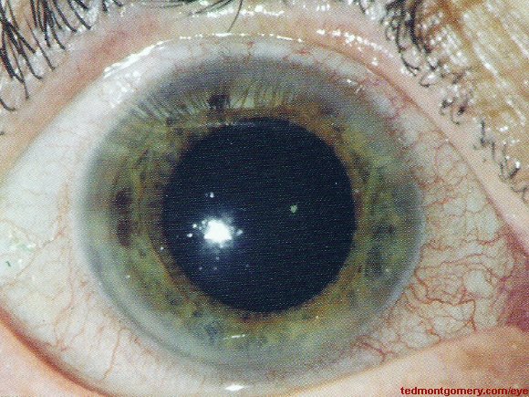 Viral Conjunctivitis